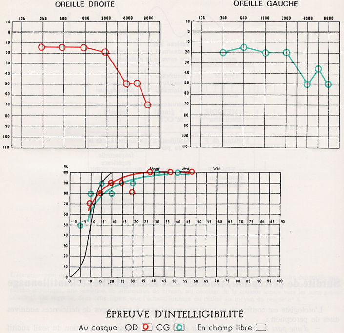 Surdité et Otites chroniques – Dr Lasfargue